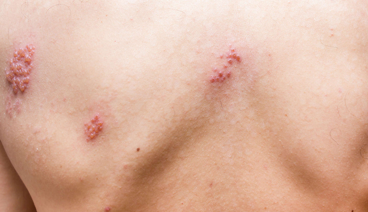 Shingles – Life Pharmacy Orewa